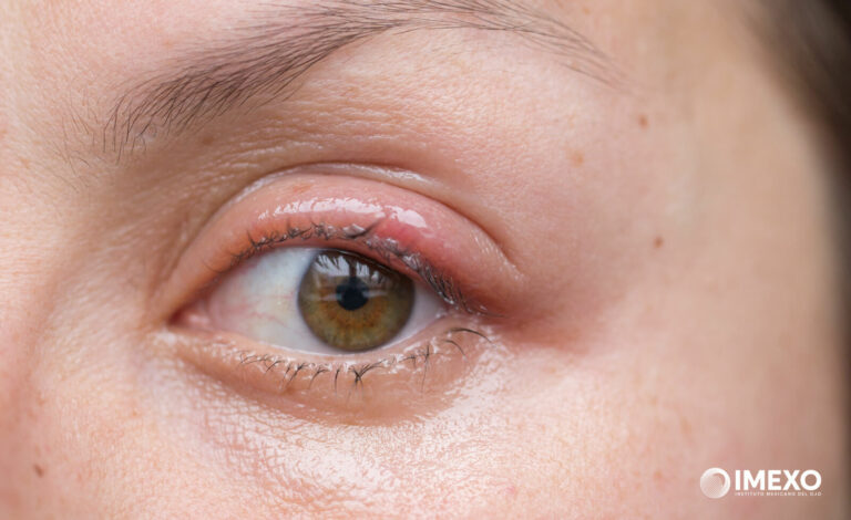 ¿Cuál es el tratamiento ideal para la blefaritis?