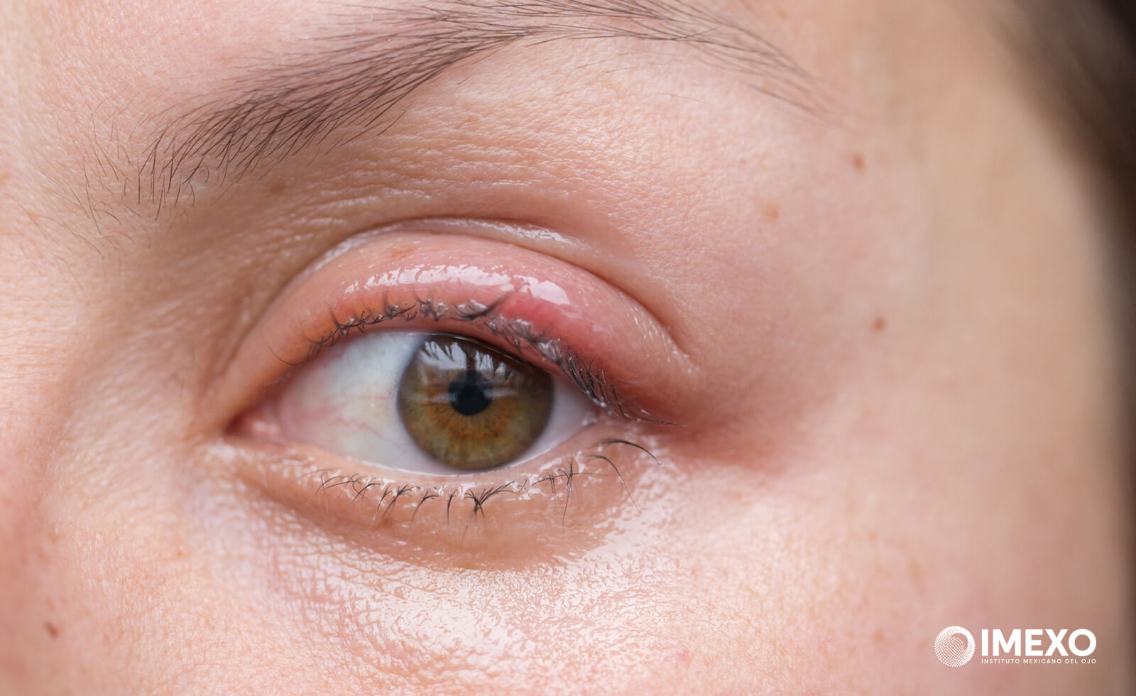 ¿Cuál es el tratamiento ideal para la blefaritis?