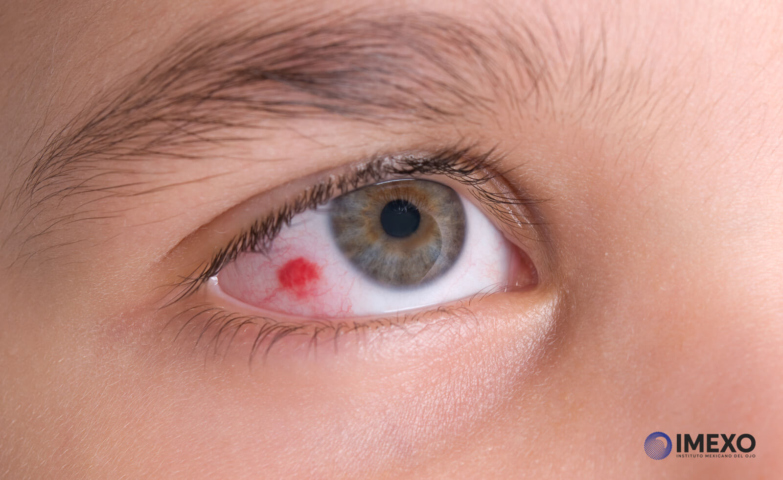 ¿Cómo quitar el punto rojo en el ojo? - Instituto Mexicano del Ojo