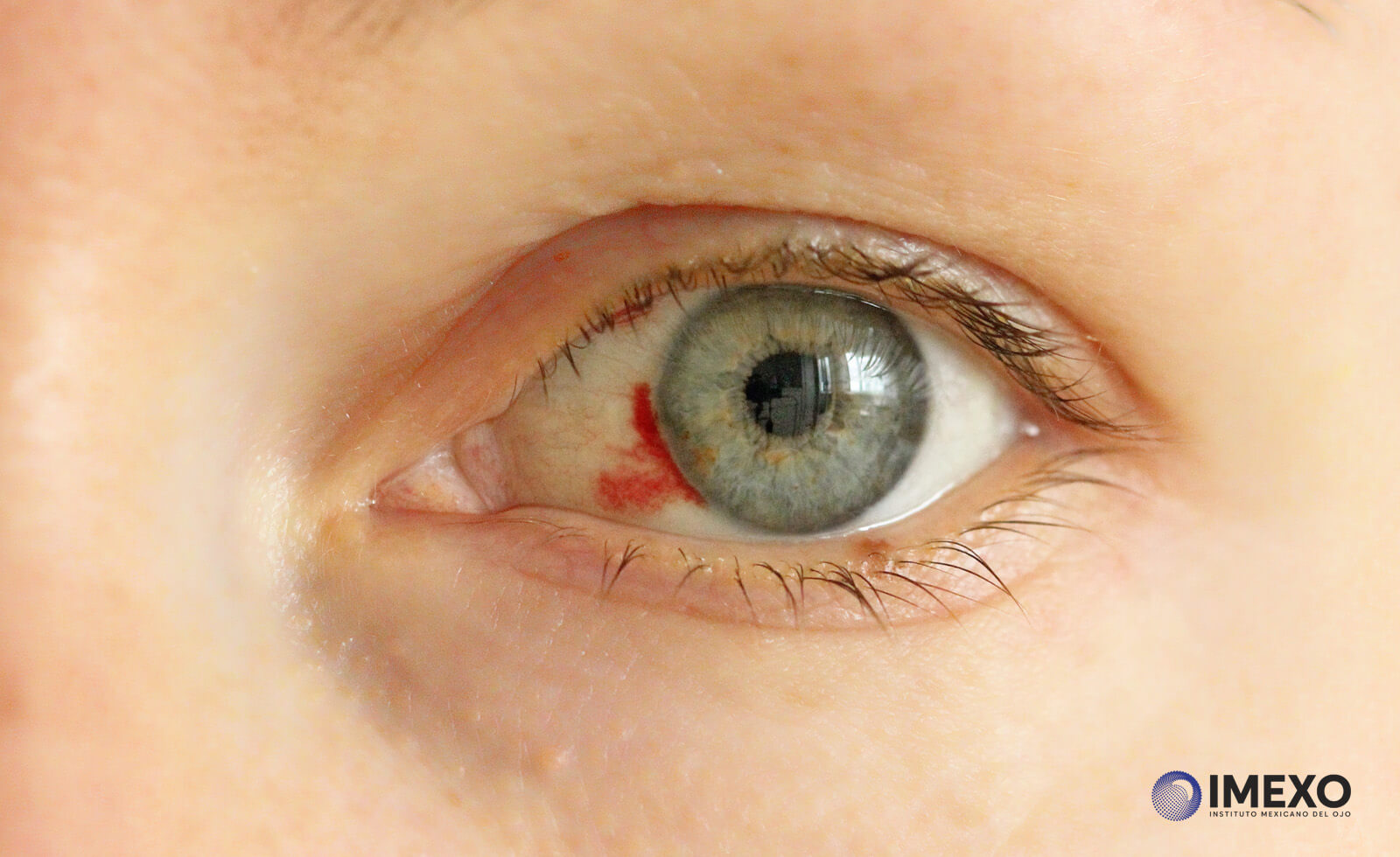 ¿Cómo quitar el punto rojo en el ojo? - Instituto Mexicano del Ojo